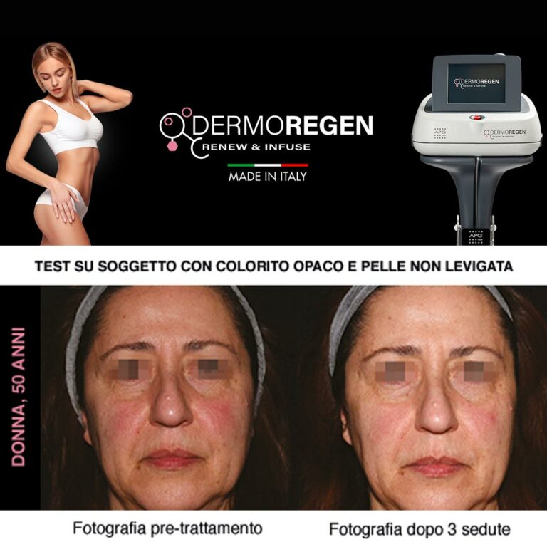 DermoRegen – Edonè Centro estetico Rieti